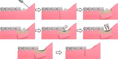 Wisdom Molar Extraction – Dr Naidu's Dental & Medical Clinic- Nadi , Fiji
